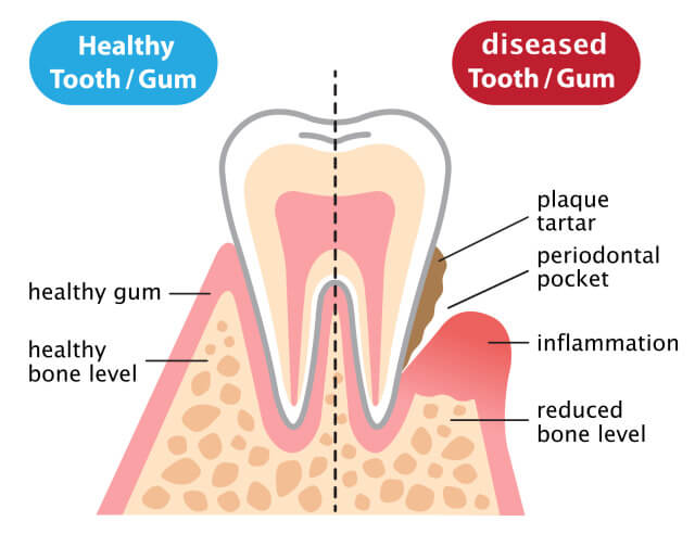 Periodontal Disease | John B. Fontana, III, DMD, MS